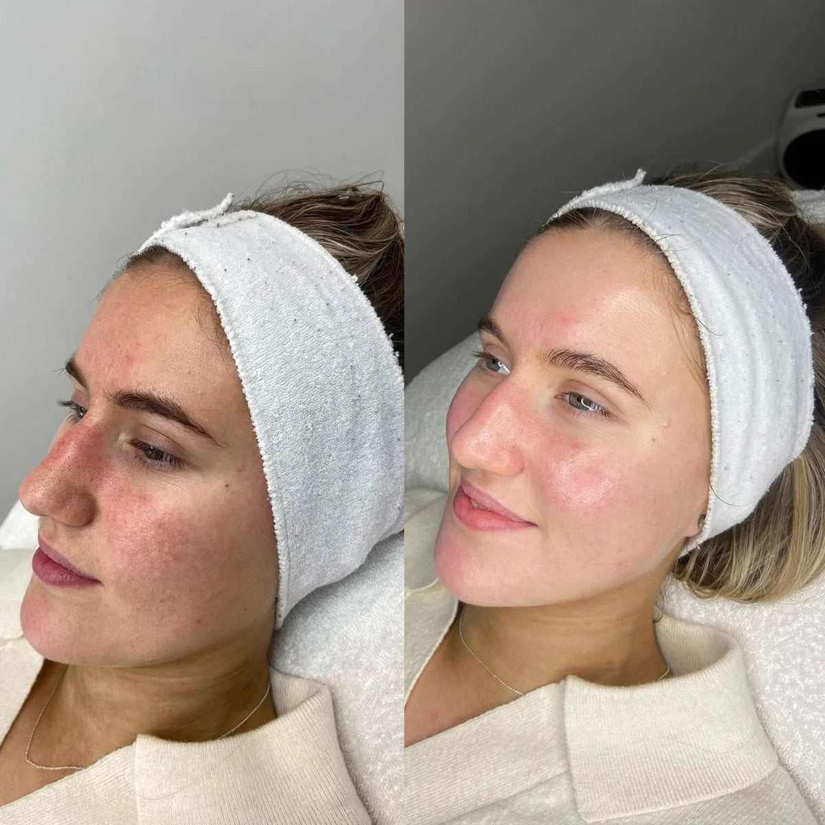 Pre & Post Procedure – Déesse PRO